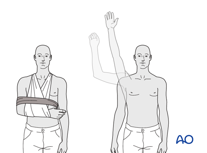 Nonoperative for 4-Part, dislocation, simple metaphyseal, intact articular