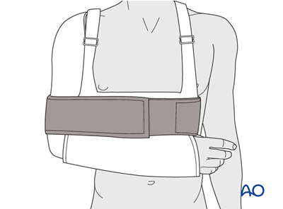 Nonoperative for Extraarticular 2-part, surgical neck, no impaction