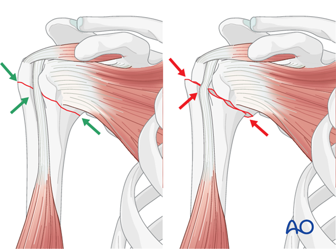 ORIF - Plate fixation for Extraarticular 2-part, surgical neck, impaction