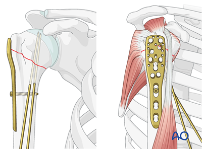ORIF - Plate fixation for Extraarticular 2-part, surgical neck, impaction