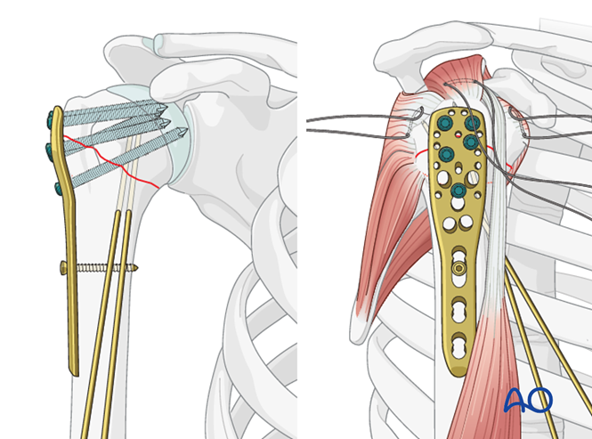ORIF - Plate fixation for Extraarticular 2-part, surgical neck, impaction