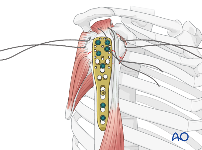 ORIF - Plate fixation for Extraarticular 2-part, surgical neck, impaction