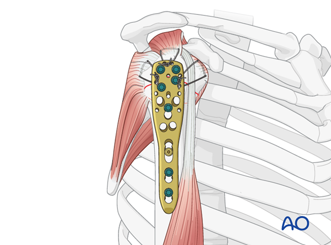 ORIF - Plate fixation for Extraarticular 2-part, surgical neck, impaction