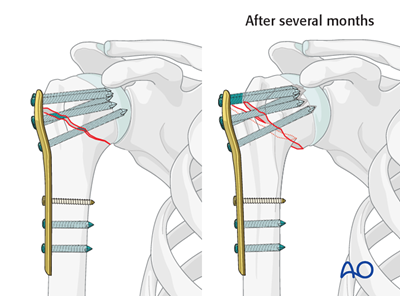 ORIF - Plate fixation for Extraarticular 2-part, surgical neck, impaction
