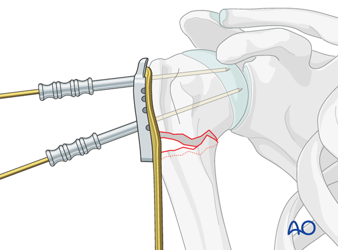 ORIF - Plate fixation for Extraarticular 2-part, surgical neck, no ...