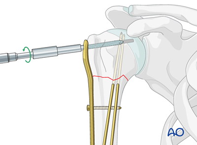 ORIF - Plate fixation for Extraarticular 2-part, surgical neck, no ...
