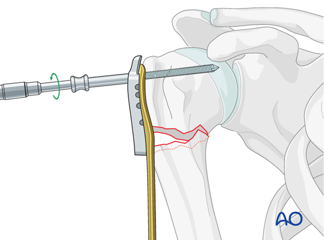 ORIF - Plate fixation for Extraarticular 2-part, surgical neck, no ...