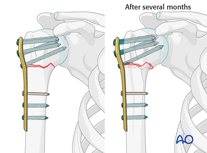 ORIF - Plate fixation for Extraarticular 2-part, surgical neck, no ...