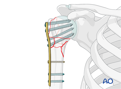 ORIF - Plate fixation for Extraarticular 3-part, surgical neck and ...