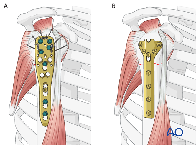 ORIF - Plate fixation for 4-Part, marked displacement, intact articular ...