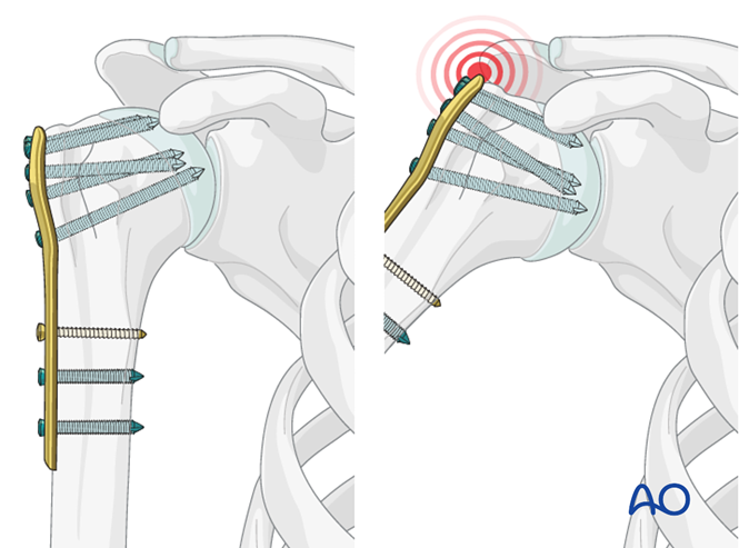 ORIF - Plate fixation for Extraarticular 2-part, surgical neck, impaction