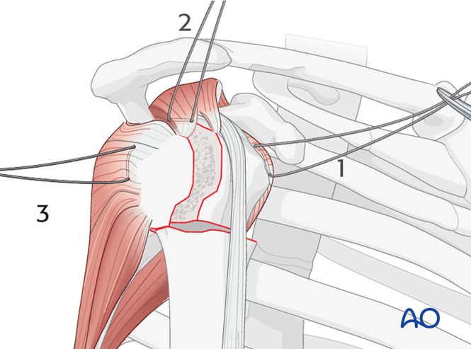 MIO - Plate fixation for Extraarticular 3-part, surgical neck and ...