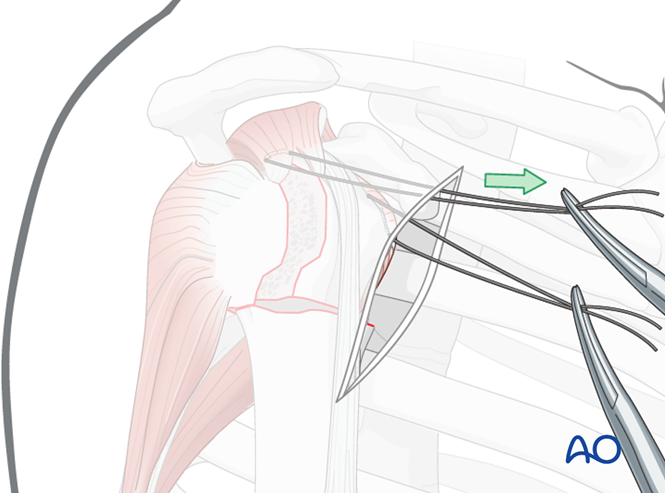 ORIF - Plate fixation for Extraarticular 3-part, surgical neck and ...