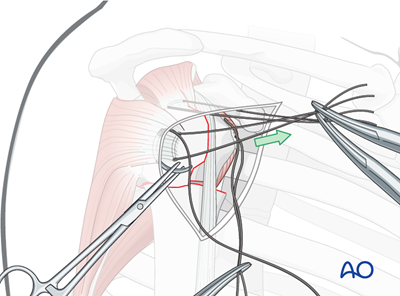 ORIF - Plate fixation for Extraarticular 3-part, surgical neck and ...