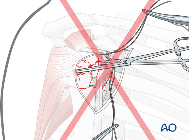 ORIF - Plate fixation for Extraarticular 3-part, surgical neck and ...
