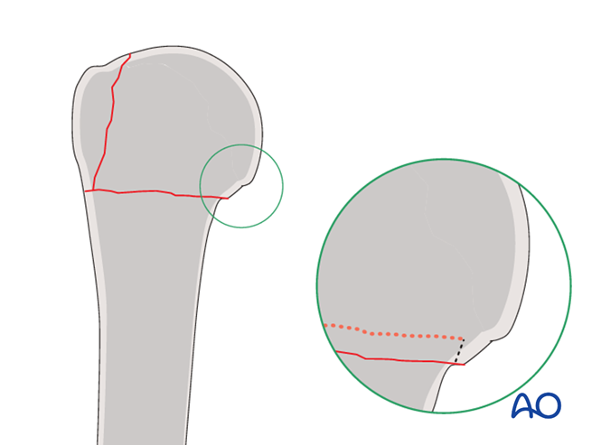 ORIF - Plate fixation for Extraarticular 3-part, surgical neck and ...