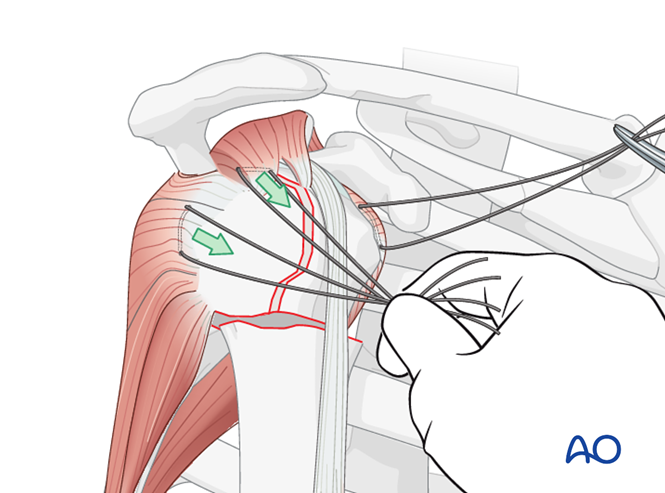 ORIF - Plate fixation for Extraarticular 3-part, surgical neck and ...