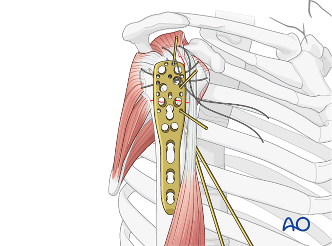 ORIF - Plate fixation for Extraarticular 3-part, surgical neck and ...