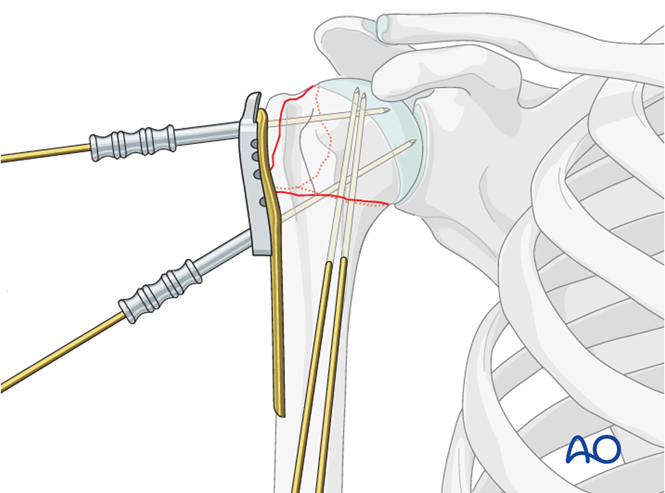ORIF - Plate fixation for Extraarticular 3-part, surgical neck and ...