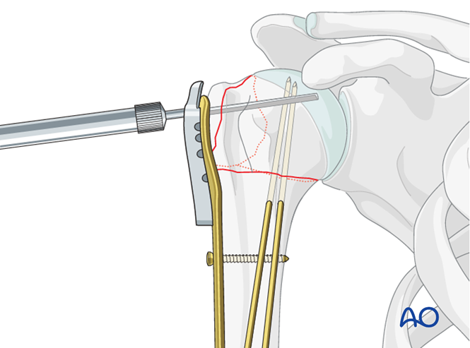 ORIF - Plate fixation for Extraarticular 3-part, surgical neck and ...