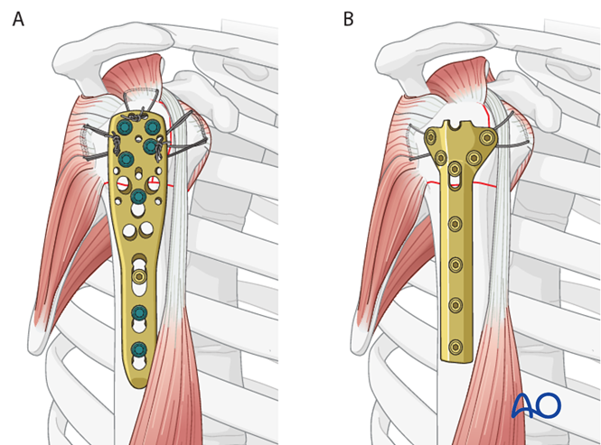 ORIF - Plate fixation for Extraarticular 3-part, surgical neck and ...
