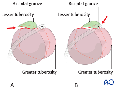 Open reduction and preliminary fixation of lesser tuberosity and ...