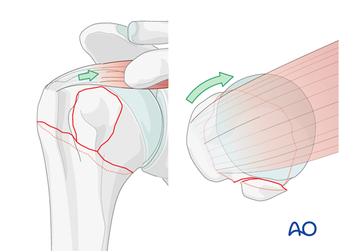 Open reduction and preliminary fixation of lesser tuberosity and ...