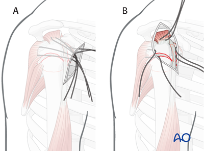 Open reduction and preliminary fixation of lesser tuberosity and ...