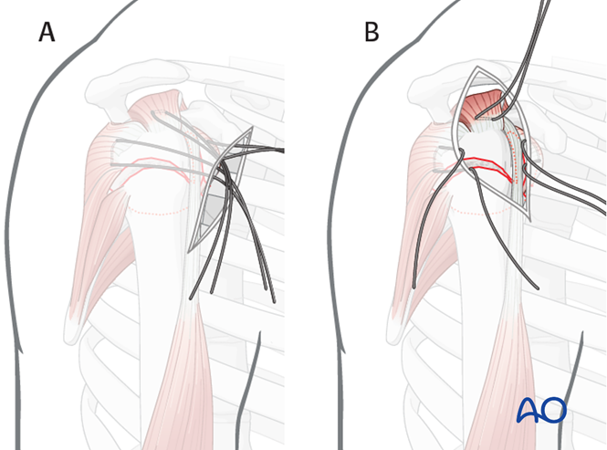 Open reduction and preliminary fixation of lesser tuberosity and ...