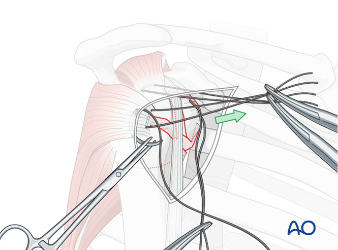 Open reduction and preliminary fixation of lesser tuberosity and ...
