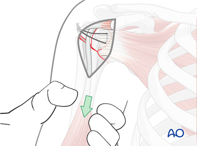 Open reduction and preliminary fixation of lesser tuberosity and ...