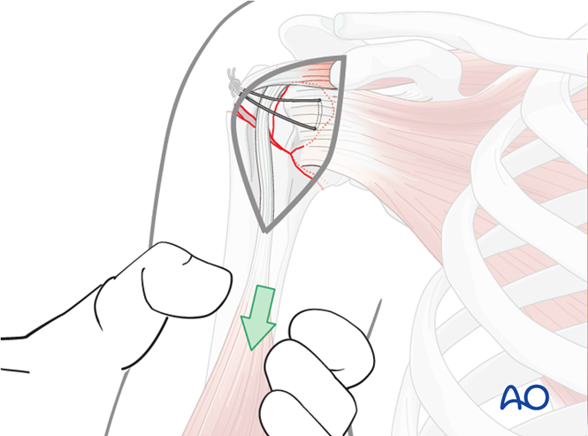 Open reduction and preliminary fixation of lesser tuberosity and ...