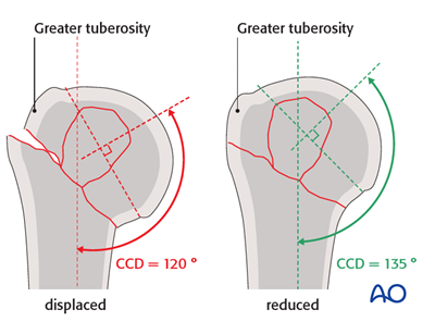 Open reduction and preliminary fixation of lesser tuberosity and ...