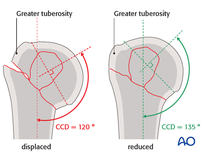 Open reduction and preliminary fixation of lesser tuberosity and ...