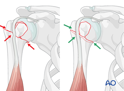 Open reduction and preliminary fixation of lesser tuberosity and ...