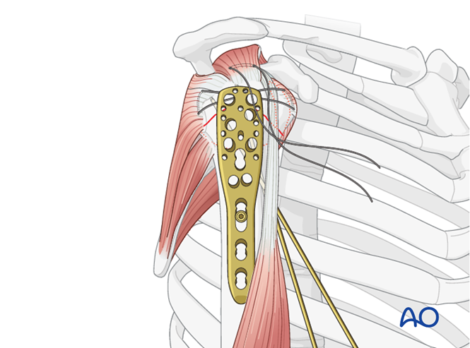 ORIF - Plate fixation for Extraarticular 3-part, surgical neck and ...
