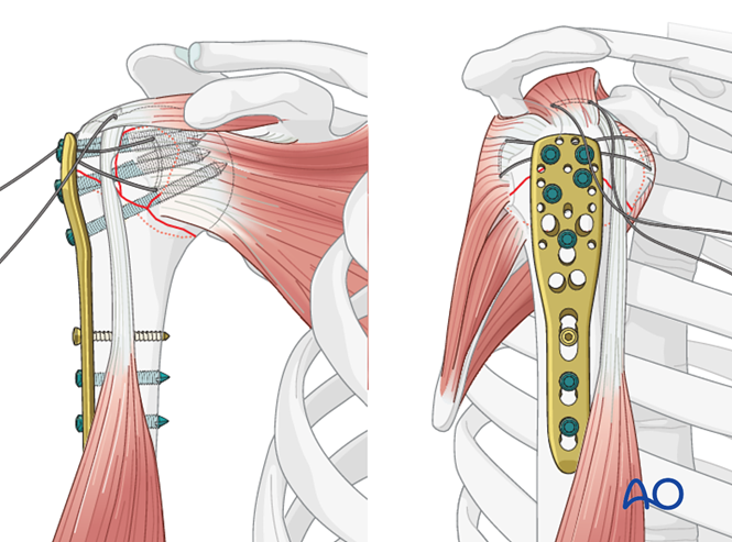 ORIF - Plate fixation for Extraarticular 3-part, surgical neck and ...