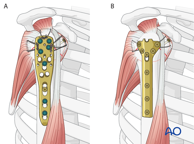 ORIF - Plate fixation for Extraarticular 3-part, surgical neck and ...