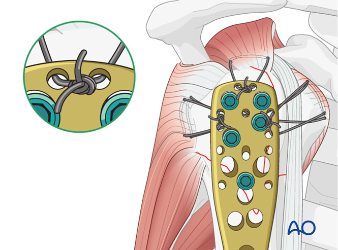 ORIF - Plate fixation for 4-Part, dislocation, fragmentary metaphyseal ...