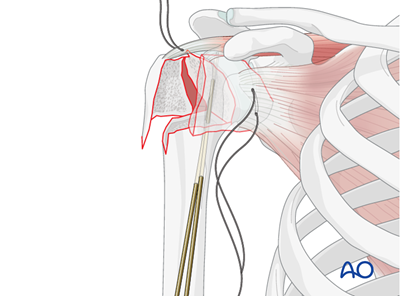 ORIF - Plate fixation for 4-Part, slight displacement, valgus malalignment