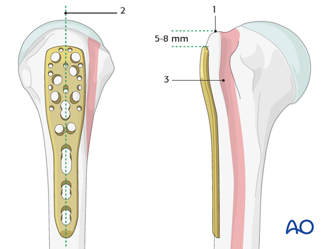 ORIF - Plate fixation for Extraarticular 2-part, surgical neck, impaction