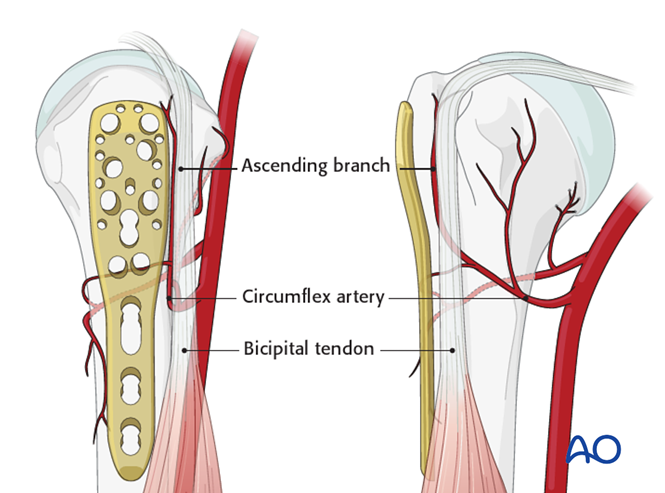 ORIF - Plate fixation for Extraarticular 2-part, surgical neck, impaction