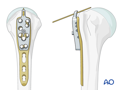 ORIF - Plate fixation for Extraarticular 2-part, surgical neck, impaction