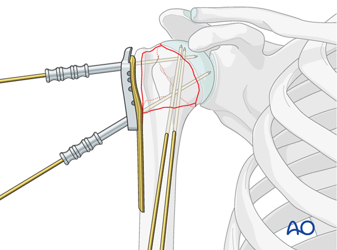 ORIF - Plate fixation for 4-Part, slight displacement, varus malalignment