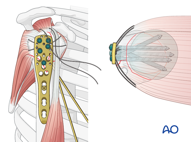 ORIF - Plate fixation for 4-Part, slight displacement, valgus malalignment