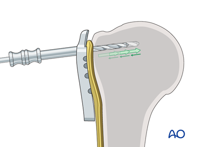 ORIF - Plate fixation for Extraarticular 2-part, surgical neck, impaction