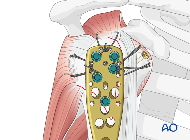 ORIF - Plate fixation for Extraarticular 3-part, surgical neck and ...