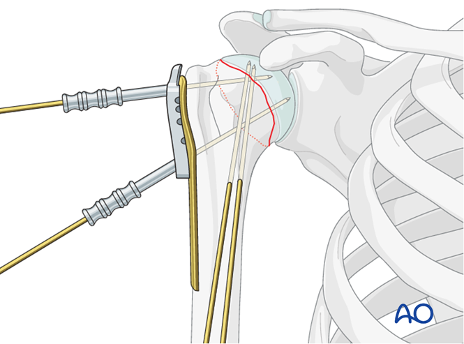 ORIF - Plate fixation for Isolated anatomical neck, slight displacement