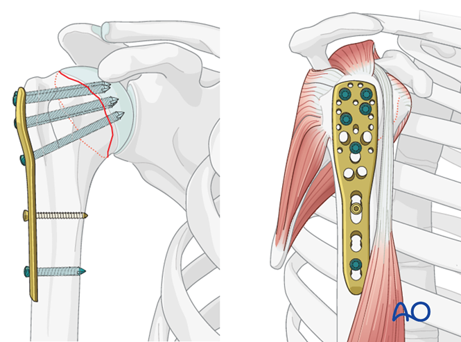 ORIF - Plate fixation for Isolated anatomical neck, slight displacement
