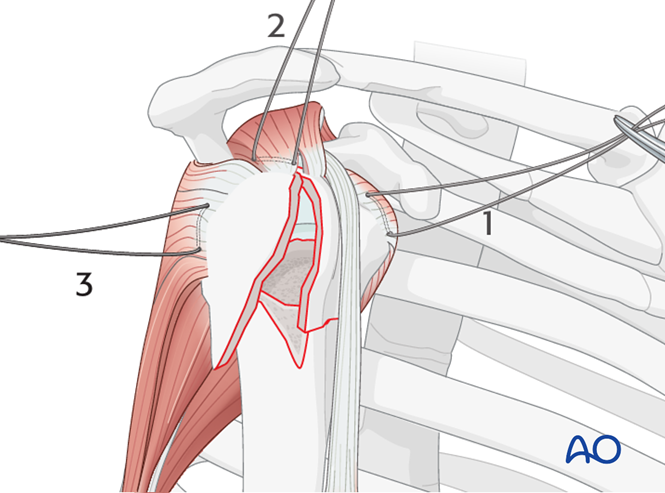 ORIF - Plate fixation for 4-Part, marked displacement, intact articular ...